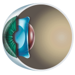 Top Implantable Contact Lens (ICL) Surgery Malaysia | VISTA
