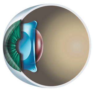 Top Implantable Contact Lens (ICL) Surgery Malaysia | VISTA